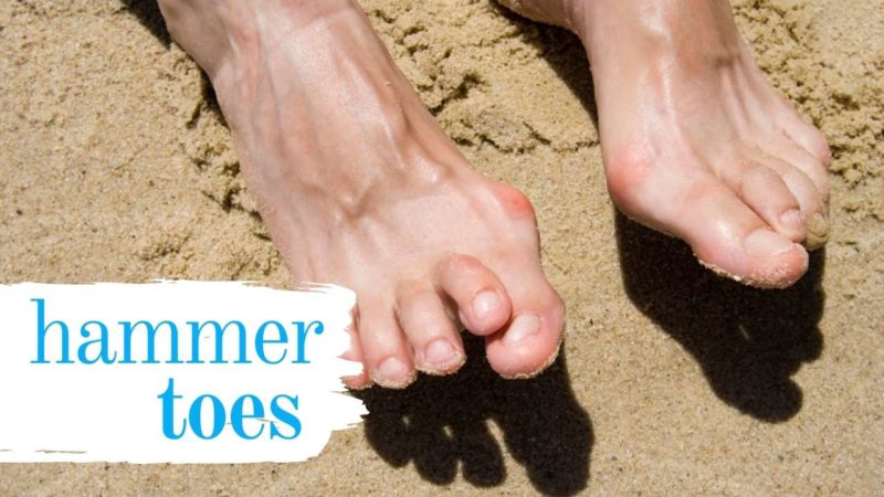 Advanced Treatment For Hammertoes - Minimally Invasive Options