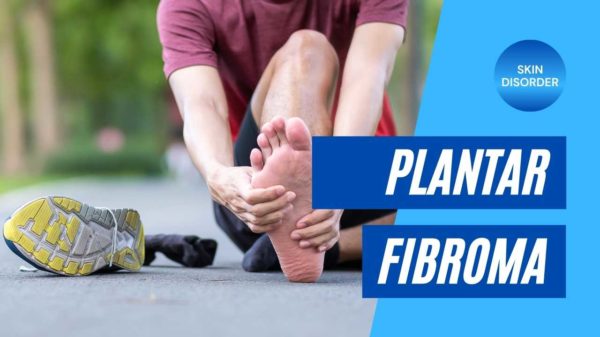 Virginia's #1 Plantar Fibroma Treatment | Achilles Foot and Ankle RVA