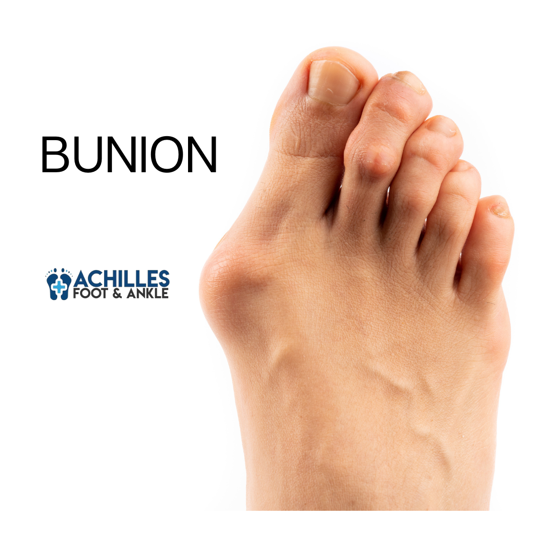 Bunion: Causes, Symptoms, and Treatment Options